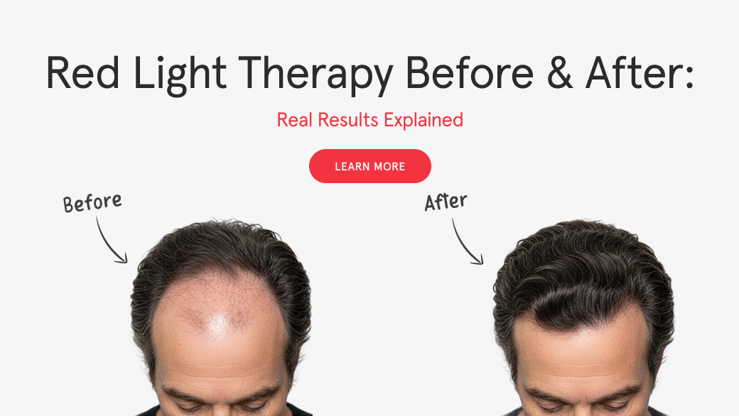 Red Light Therapy Before & After: Real Results Explained – iRESTORE ...