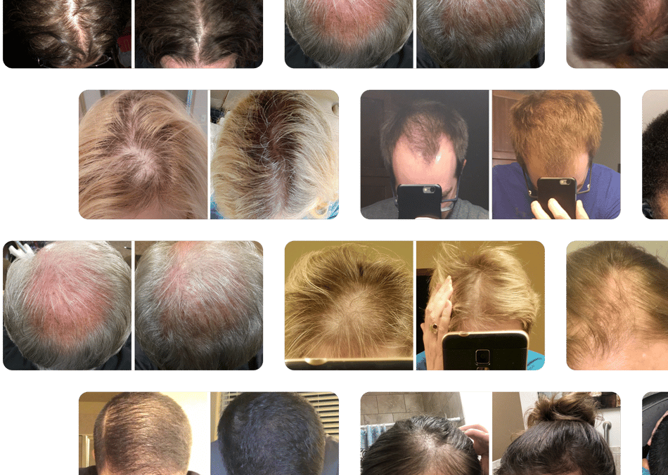 💬1 Before And After Photos Laser Hair Growth Therapy Irestore Reviews Irestore Hair Growth