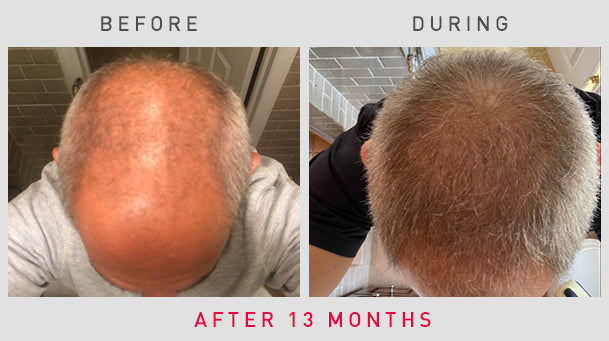 Before & After Photos – Laser Hair Growth Therapy | iRestore Reviews ...