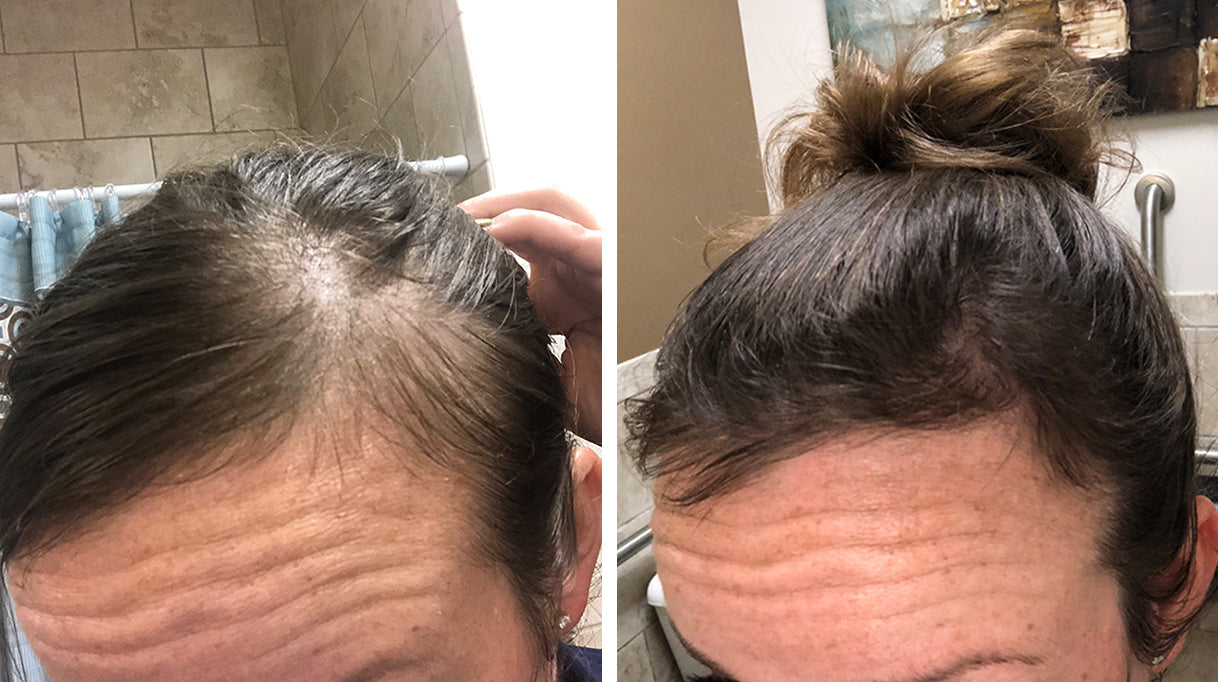 iRestore Laser Hair Growth System – FDA-Cleared Hair Loss Treatment ...