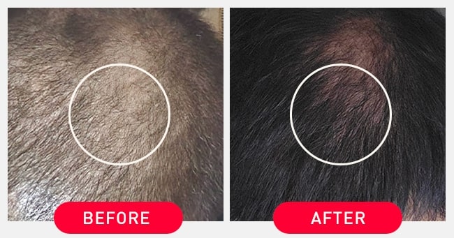 iRestore Laser Hair Growth System | FDA-Cleared Hair Loss Treatment