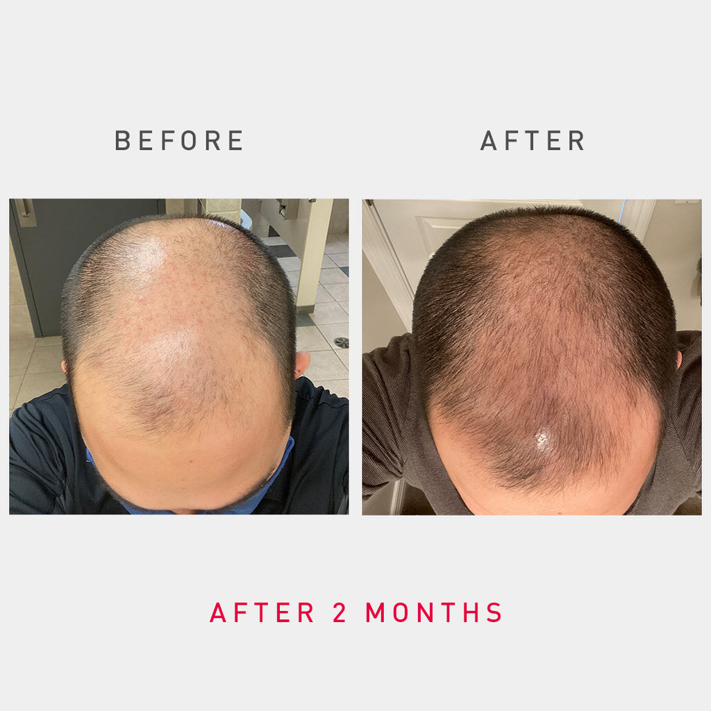 iRestore Laser Hair Growth System | FDA-Cleared Hair Loss Treatment