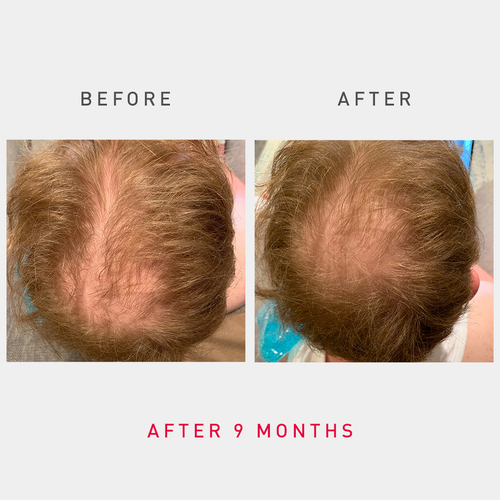 iRestore Laser Hair Growth System | FDA-Cleared Hair Loss Treatment