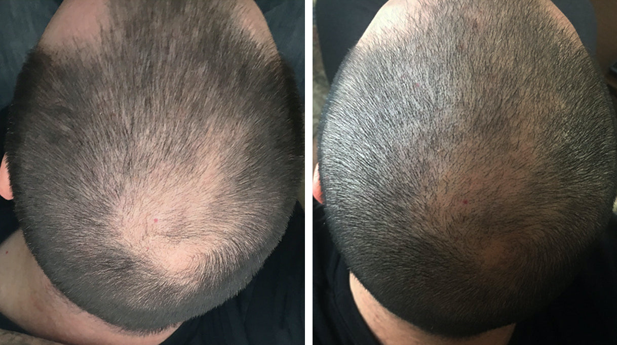 iRestore Laser Hair Growth System – FDA-Cleared Hair Loss Treatment ...