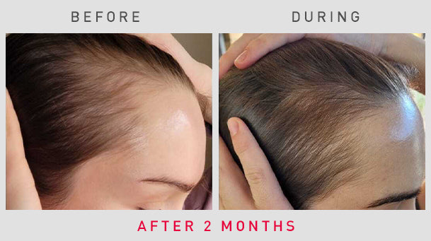Before & After Photos – Laser Hair Growth Therapy | iRestore Reviews ...